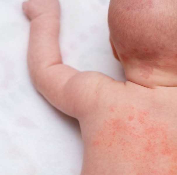 Brotoeja O Que é E Tratamento Em Bebê Minha Vida